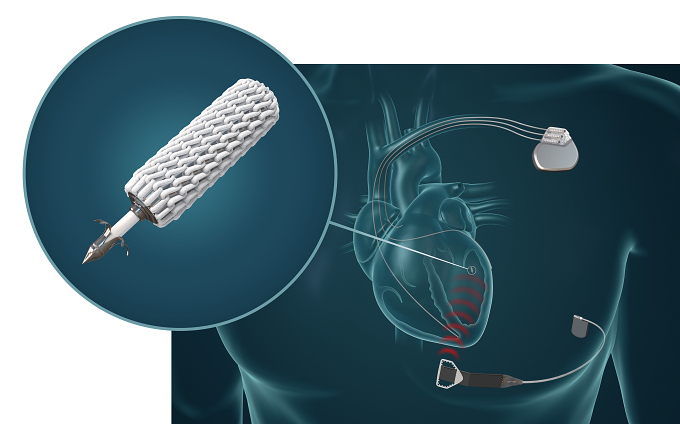 Endocardial Stimulation. 3 Different approaches. by Martin Woodward