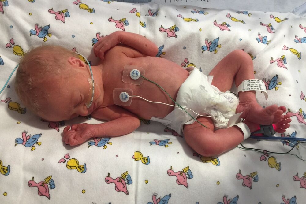 My 33 weeker - Natasha's story | Bliss